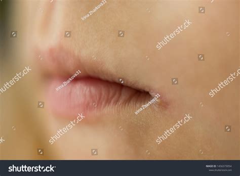 Skin Problems Angulitis Angular Stomatitis Angular Foto Stok 1456373054 Shutterstock