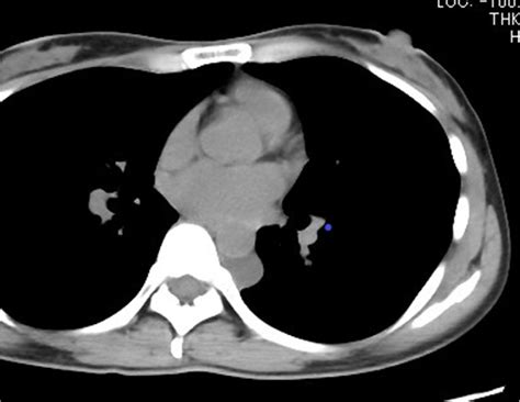 Chest Ct Showing Prevertebral Cystic Tumor Download Scientific Diagram