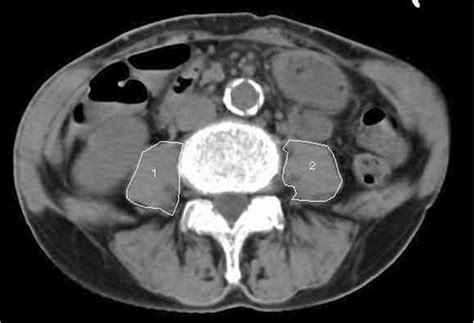 Measurement Of The Psoas Muscle Area On Preoperative Ct Crosssectional