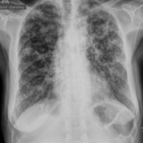 Chest Radiograph Frontal Projection Post Treatment The Previously