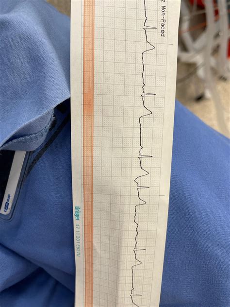 What Would U Call These Ectopic Beats R Ecg