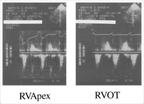 Comparison Of Right Ventricular Outflow Tract And Apical Lead Permanent