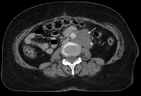 the follow up ct scan showed interval regression in the size of the