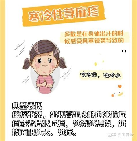 引发寒冷性荨麻疹的原因是什么？ 知乎