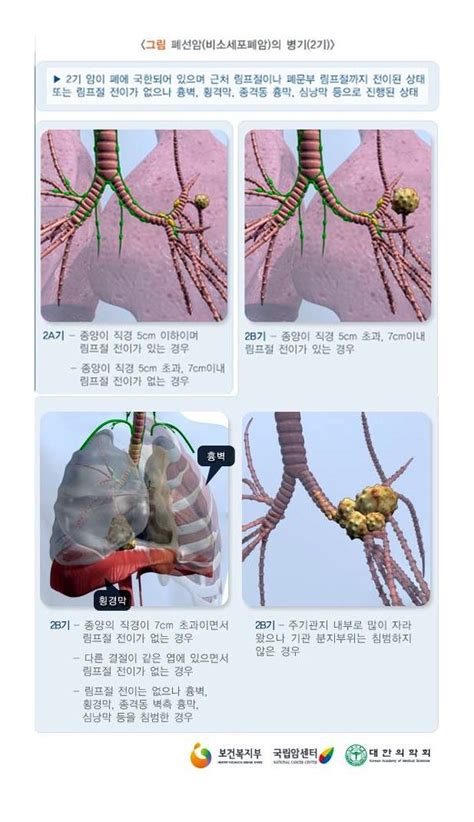 비소세포폐암의 정의 및 종류 네이버 블로그