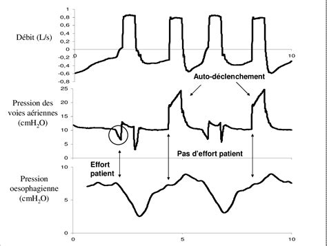 Figure 12 From Asynchronies Patient Ventilateur Au Cours De La Ventilation Assistée Semantic