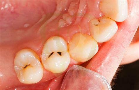 Teeth Rotting From The Inside Out Causes Prevention And Treatment