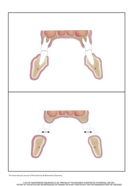 Pdf An Interarch Alveolar Ridge Relationship Classification