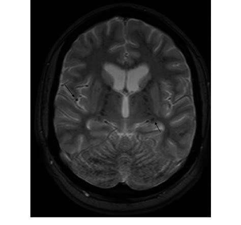 T2 Weighted Gradient Echo Images Through The Head Reveal Numerous Download Scientific Diagram