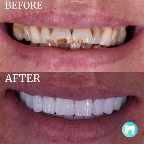 Affordable Dental Implants In Turkey Cost Patients Reviews