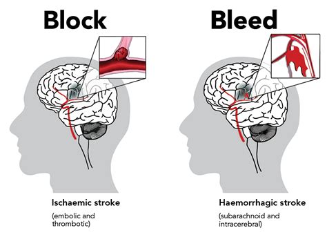 Stroke Diagram Quizlet