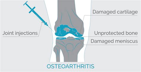 Joint Injections Nordorthopaedics