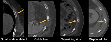 갈비뼈 골절 Rib Fracture 네이버 블로그