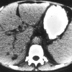 PDF Acute Cholangitis