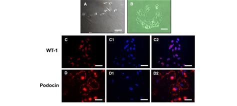 Urine Cells Grown In Culture And Cells Stained With Wt 1 And Podocin