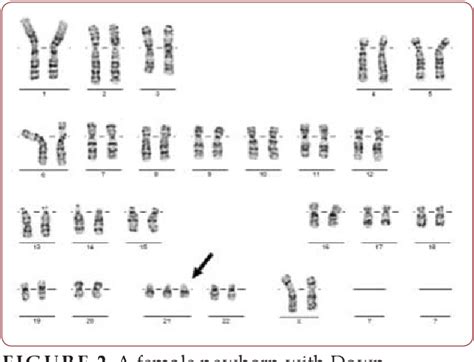 Figure 2 From Down Syndrome Genetics And Cardiogenetics Semantic