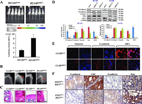 Hic1 Loss Enhances Pca Metastasis Through Emt A Top Representative