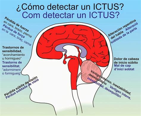Rehabilitación Domiciliaria Tras Un Ictus En Madrid 675398810