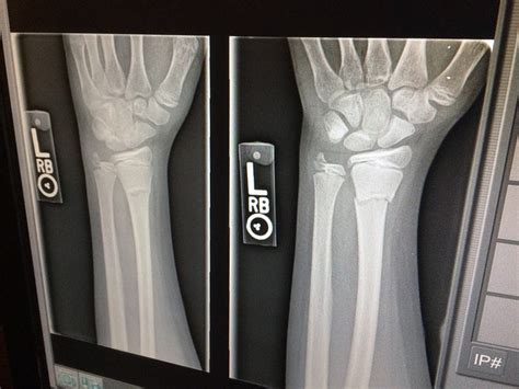 Nsaids In A Patient With Fractures — Taming The Sru