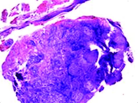 Upper And Lower Dermal Nodular Granulomatous Infiltrates H And E ×10 Download Scientific
