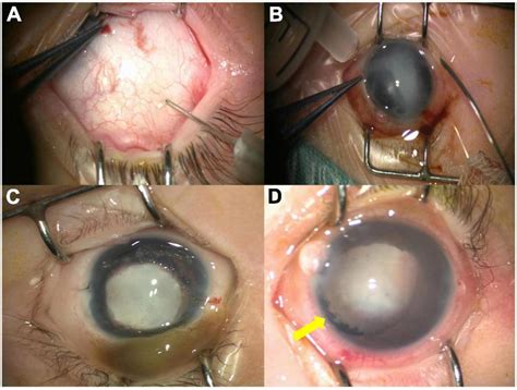 The Disadvantages Of External Drainage Of Subretinal Fluid Srf