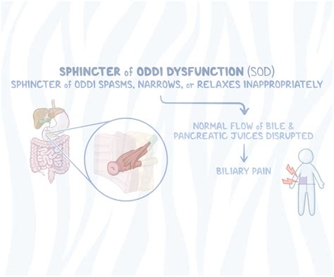 Sphincter Of Oddi Dysfunction