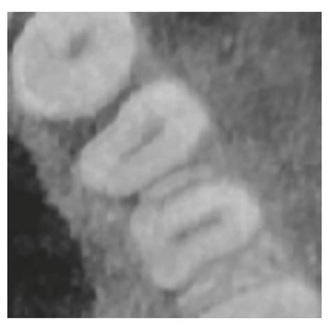 Different Variations Of Root Canal Types In Mandibular First Premolar