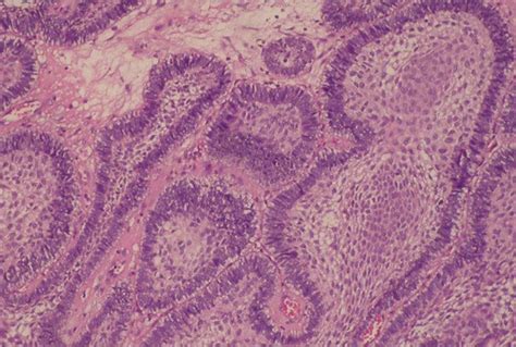 Plexiform Pattern Of Ameloblastoma Hematoxylin Eosin Stain Original Download Scientific
