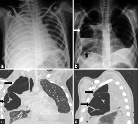Lung Abscess Due To Streptococcal Pneumonia In A 15 Year Old Girl A