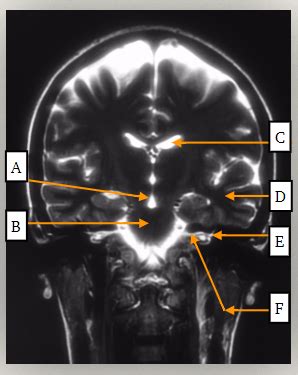 Mri Anatomy Of Inner Auditory Canal Flashcards Quizlet