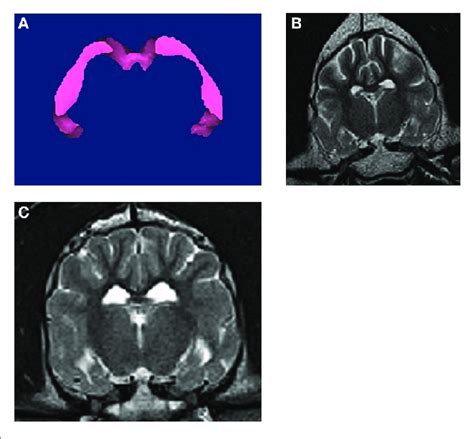 A 3d Volumetric Analysis Of The Hippocampus B T2w Transverse Mri