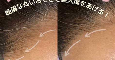綺麗なおでこは美人の条件？🫢💞【館林のトータル脱毛サロン】 レディース 美容サービスへのこだわりや人気の理由をご紹介するブログ