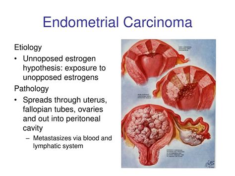 Ppt Endometrial Cancer Powerpoint Presentation Free Download Id221956
