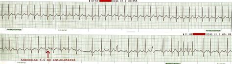 Ekg 69 Svtadenosine