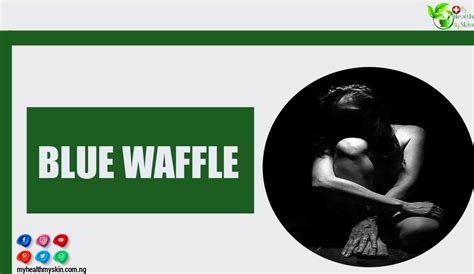 Blue Waffle Disease Symptoms Causes Is It Real