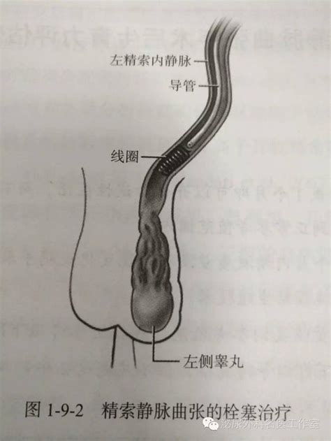 精索靜脈曲張的介入治療及要點第九章 每日頭條