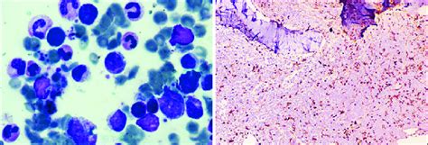 A Myelodysplastic Syndrome Excess Blasts Bone Marrow Aspiration