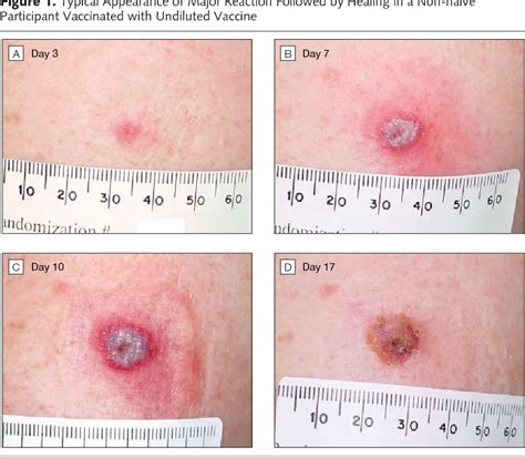 Smallpox Vaccine Reaction