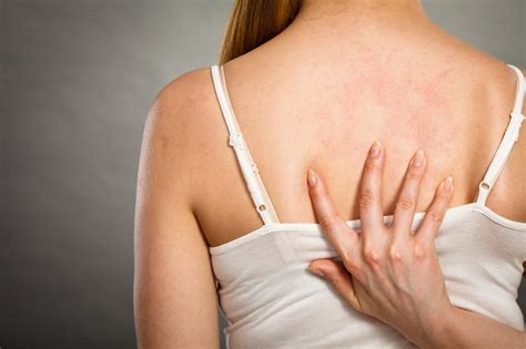 Malar Rash Explained The Butterfly Rash Age Defying Skin Care By Dr