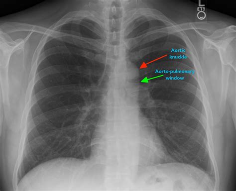Αποτέλεσμα εικόνας για aortic arch chest x ray Interpretation X ray