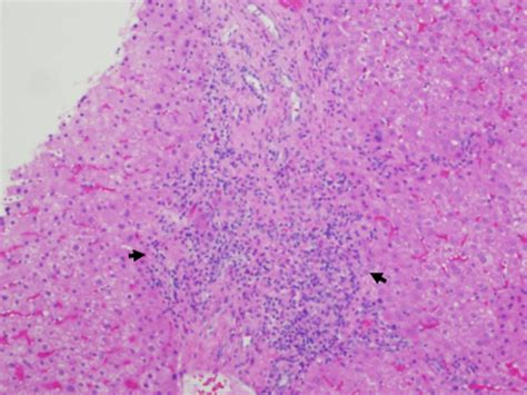 Infliximab Induced Autoimmune Hepatitis Bmj Case Reports