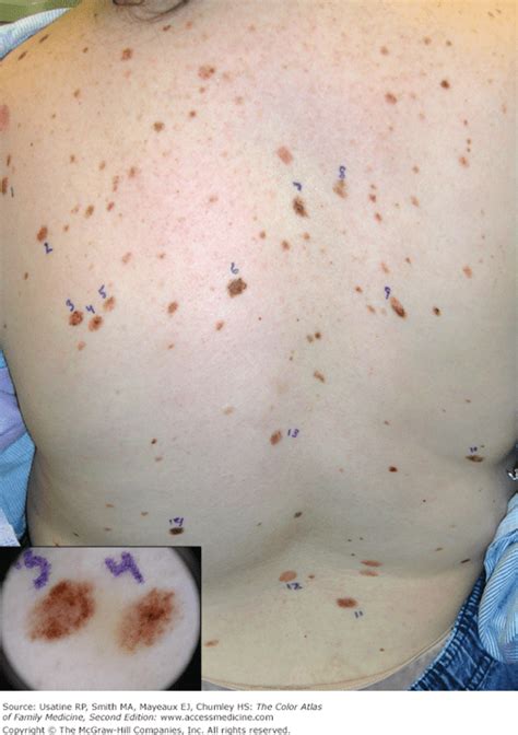 Cutaneous Horn Basicmedical Key