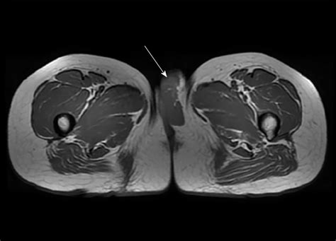 Pelvic Enhanced Nuclear Magnetic Resonance Scan Revealing A Cystic Area