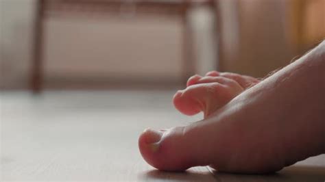 Closeup Of A Large Abscess On A Persons Big Toe Showcasing A Purulent