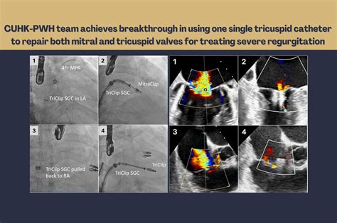 Cuhk Pwh Team Achieves Breakthrough In Using One Single Tricuspid