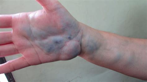 What Is Blue Rubber Bleb Nevus Syndrome Laurel Clinical
