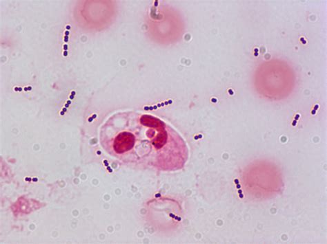 Erysipelas