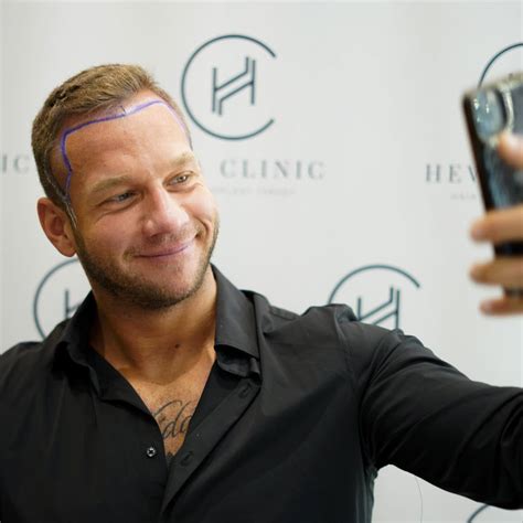 Blonde Hair Transplant Procedure And Costs Heva Clinic Turkey