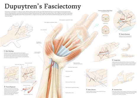 Dupuytrens Fasciectomy On Behance