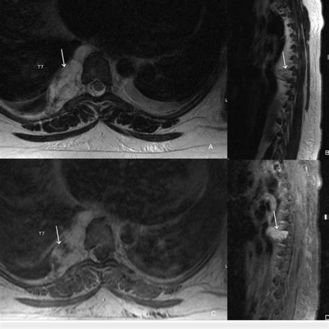 Postoperative Mri Of The Thoracic Spine Contrastenhanced T2 Weighted
